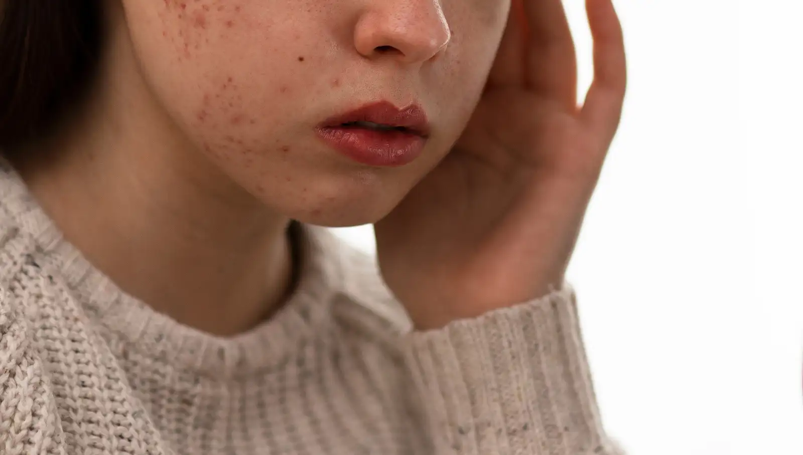 Acne Scars, Trauma Scars, and More: Laser Treatment Help?